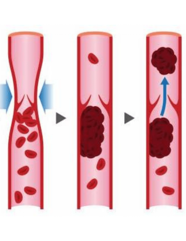 Deep Vein Thrombosis Treatment Munster IN - Expert DVT Care IN